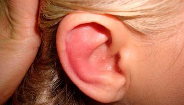 Otite - Causas, sintomas e tratamento da inflamação de ouvido