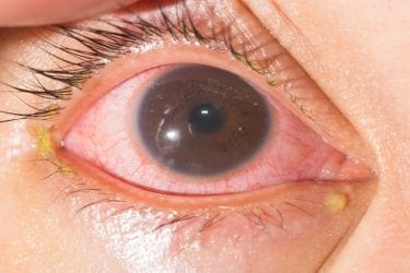 Olhos vermelhos - 10 causas mais comuns do problema
