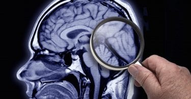 Amnésia, o que é e como saber se você tem? Tipos, causas e tratamentos