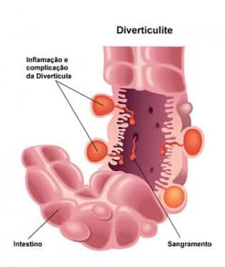 Diverticulite, o que é? Causas, sintomas, tratamentos e como evitá-la