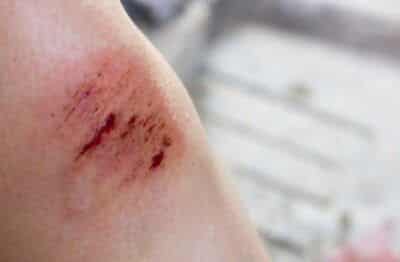 Machucados - Causas, tipos e o que fazer quando acontece