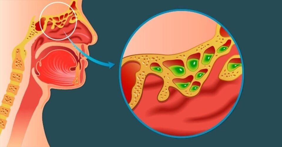 O que é coriza? Causa, para que serve e tratamentos