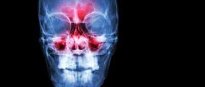 O que é coriza? Causa, para que serve e tratamentos