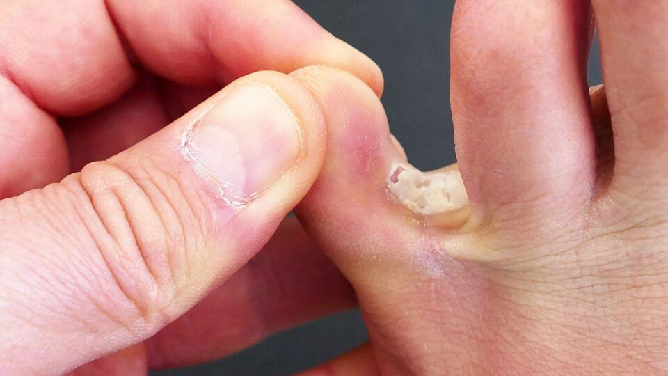 Tipos de micose, quais são? Principais características e prevenção